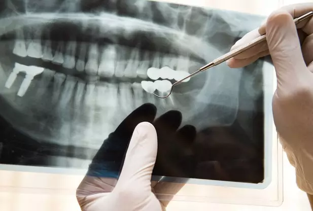 Biozobsy prichádzajú na zubné implantáty