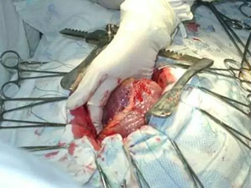 Otevřená operace srdce