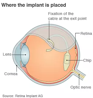 Chip, geïmplanteerd in het oog, kunt u navigeren en lezen